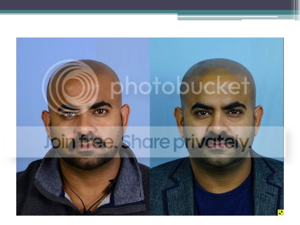 Shapiro Medical Group - Shaved effect/Alopecia Areata repair | Hair ...